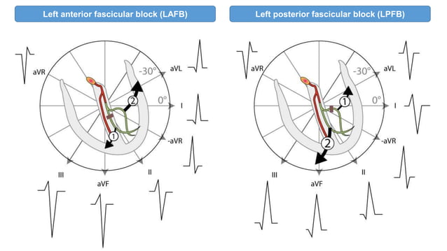 ECG - Conduction defects - Hoang Van Cuong HMU | PPT