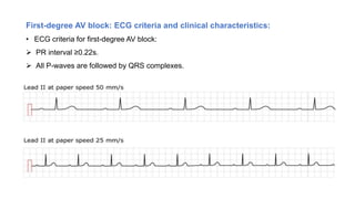 ECG - Conduction defects - Hoang Van Cuong HMU | PPT