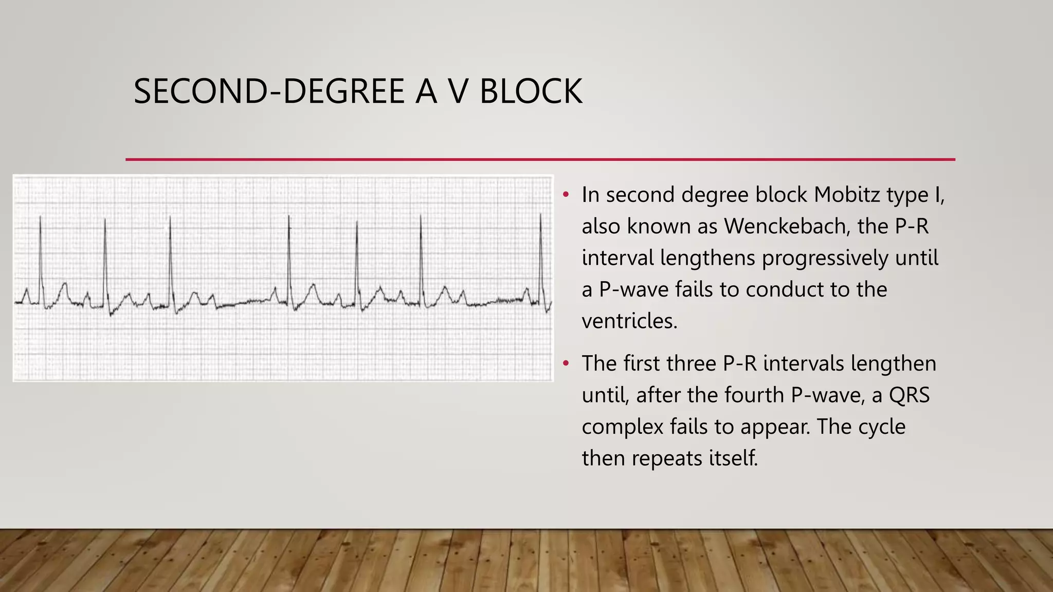 ABNORMAL ECG PART-2: CONDUCTION DIFFICULTY . | PPT