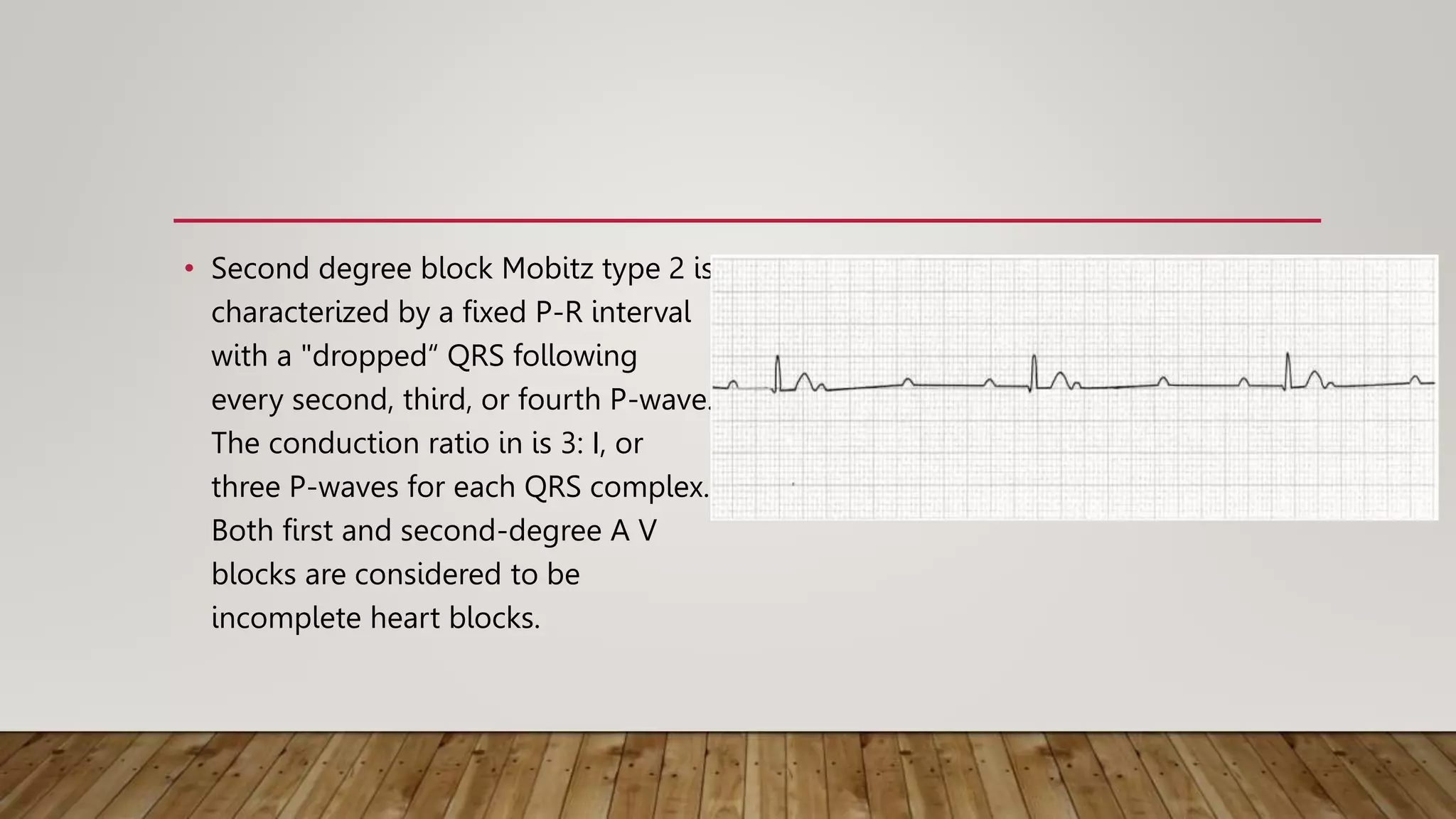 ABNORMAL ECG PART-2: CONDUCTION DIFFICULTY . | PPT