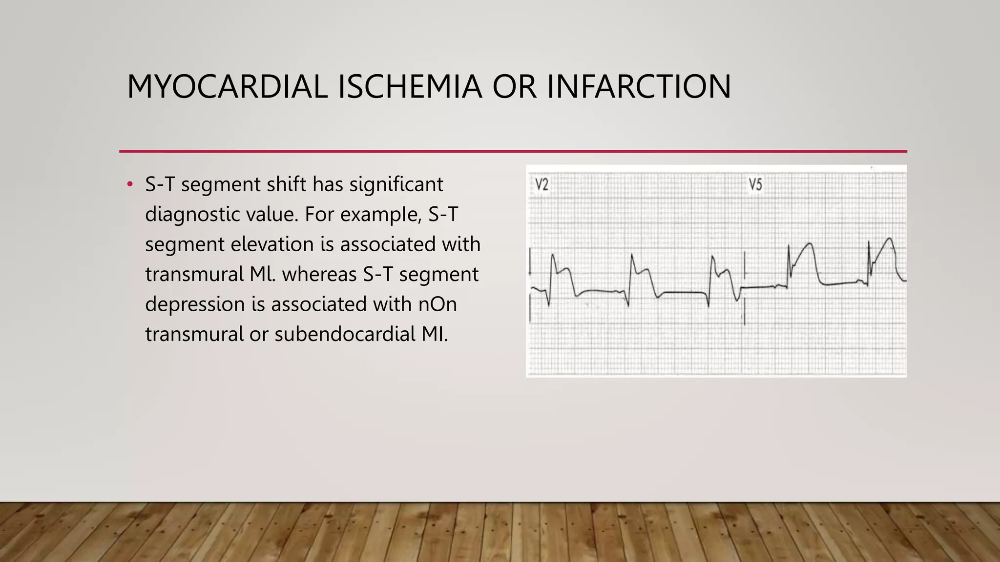 ABNORMAL ECG PART-2: CONDUCTION DIFFICULTY . | PPT
