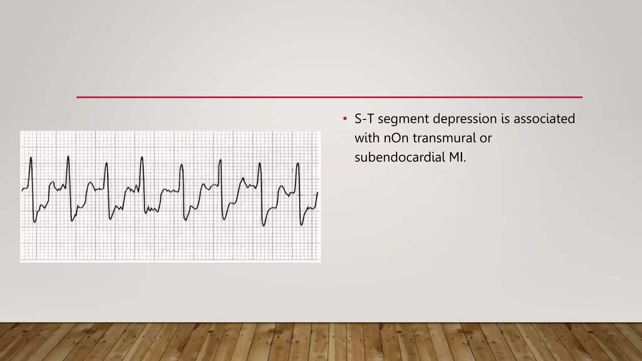 ABNORMAL ECG PART-2: CONDUCTION DIFFICULTY . | PPT