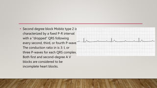 ABNORMAL ECG PART-2: CONDUCTION DIFFICULTY . | PPT