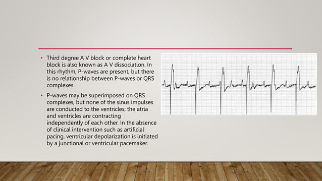 ABNORMAL ECG PART-2: CONDUCTION DIFFICULTY . | PPT