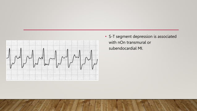 ABNORMAL ECG PART-2: CONDUCTION DIFFICULTY . | PPT