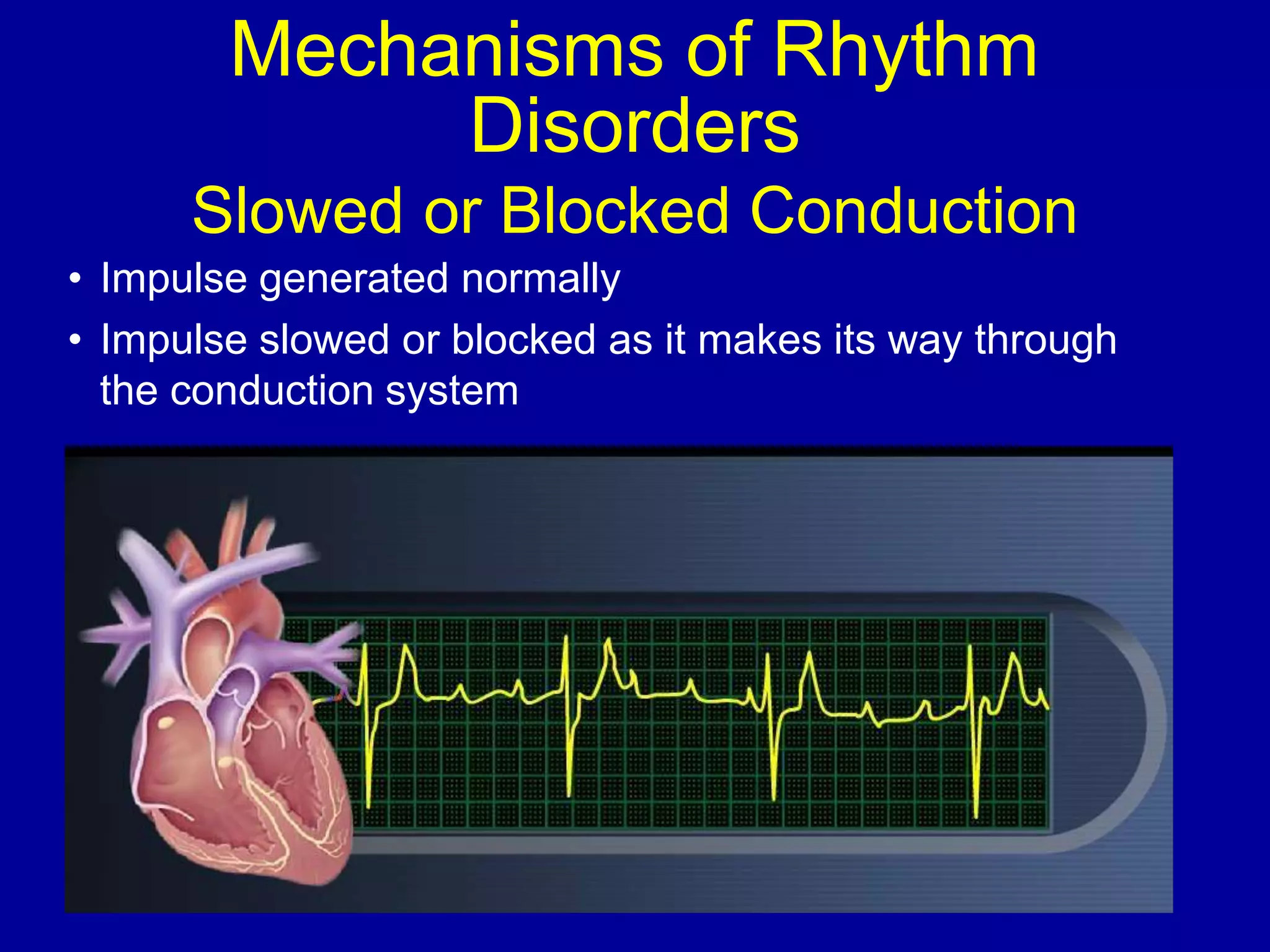 Conduction Disorders | PPTX