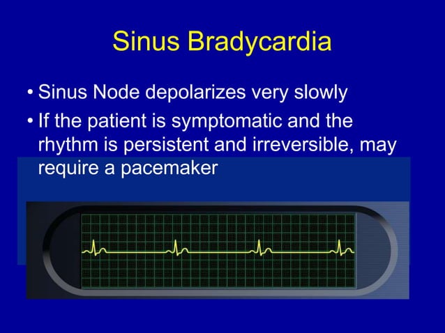 Conduction Disorders | PPTX | Heart and Cardiovascular Diseases ...