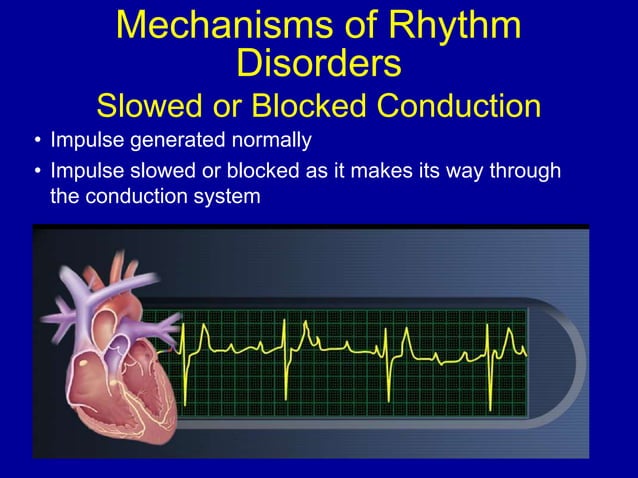 Conduction Disorders | PPTX | Heart and Cardiovascular Diseases ...