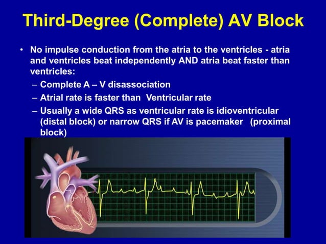 Conduction Disorders | PPTX | Heart and Cardiovascular Diseases ...
