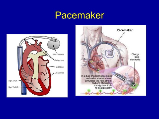 Conduction Disorders | PPTX | Heart and Cardiovascular Diseases ...