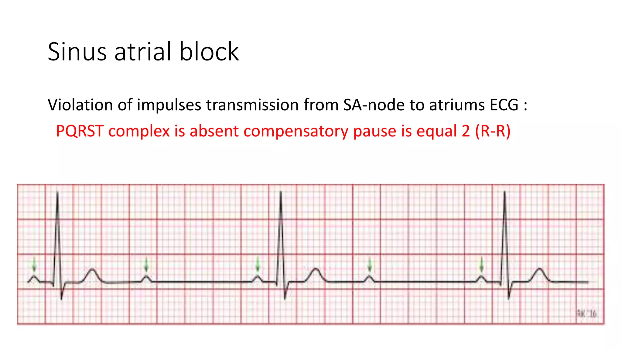 Conduction disorders.pptx