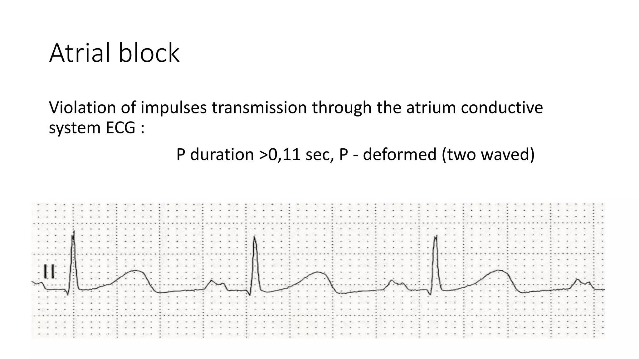 Conduction disorders.pptx
