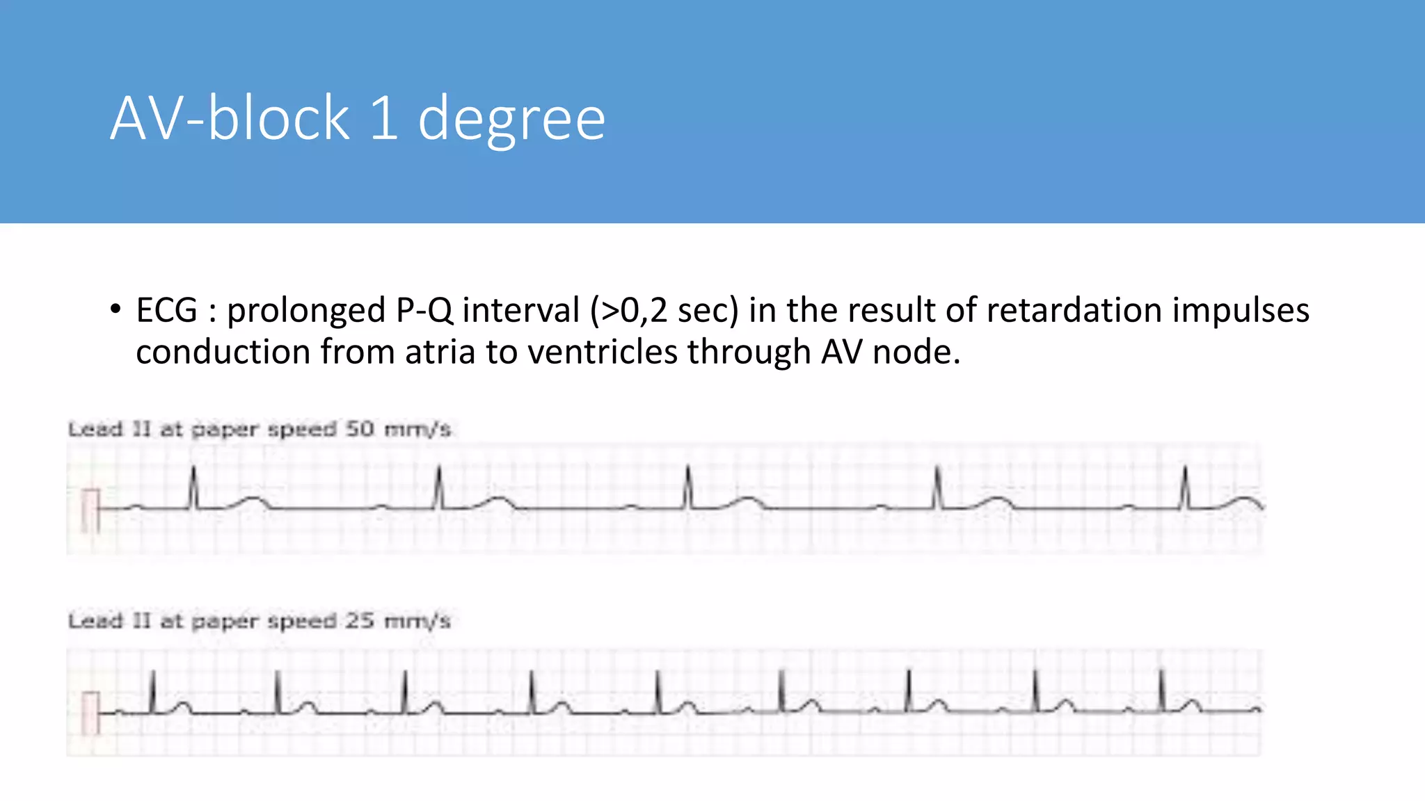 Conduction disorders.pptx
