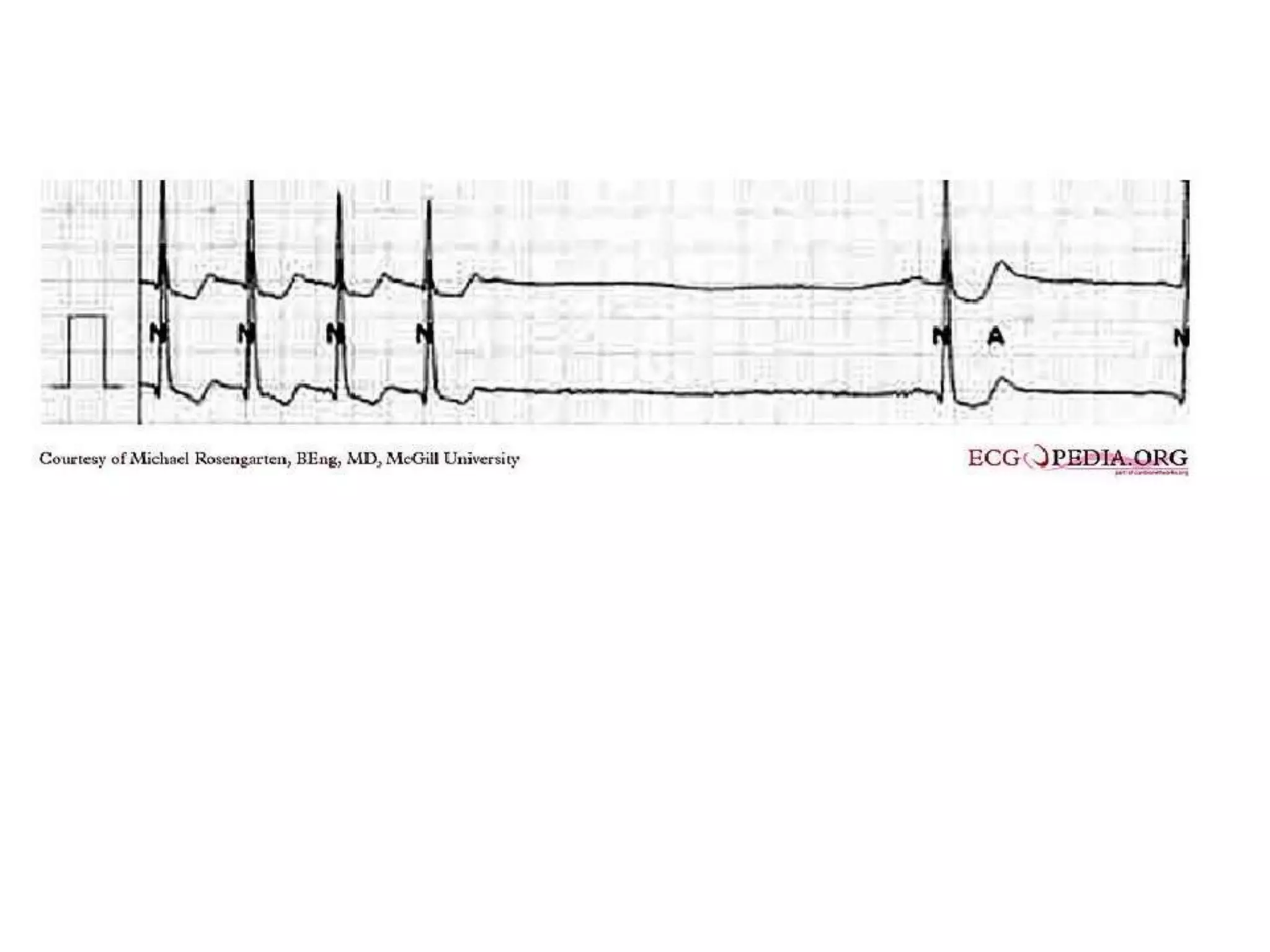 Conduction disorders with sinoatrial blocks Dr Walinjom | PPTX | Heart ...