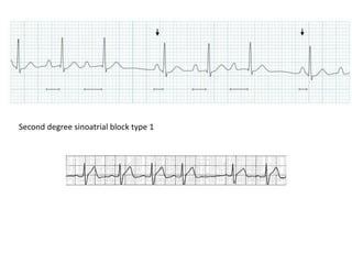 Conduction disorders with sinoatrial blocks Dr Walinjom | PPTX