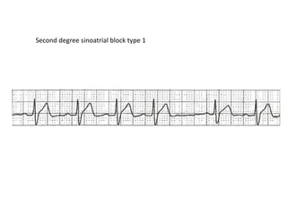 Conduction disorders with sinoatrial blocks Dr Walinjom | PPTX