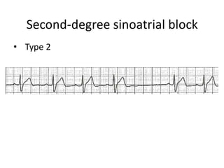 Conduction disorders with sinoatrial blocks Dr Walinjom | PPTX