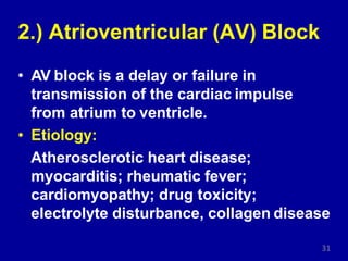Conduction disorders with sinoatrial blocks Dr Walinjom | PPTX