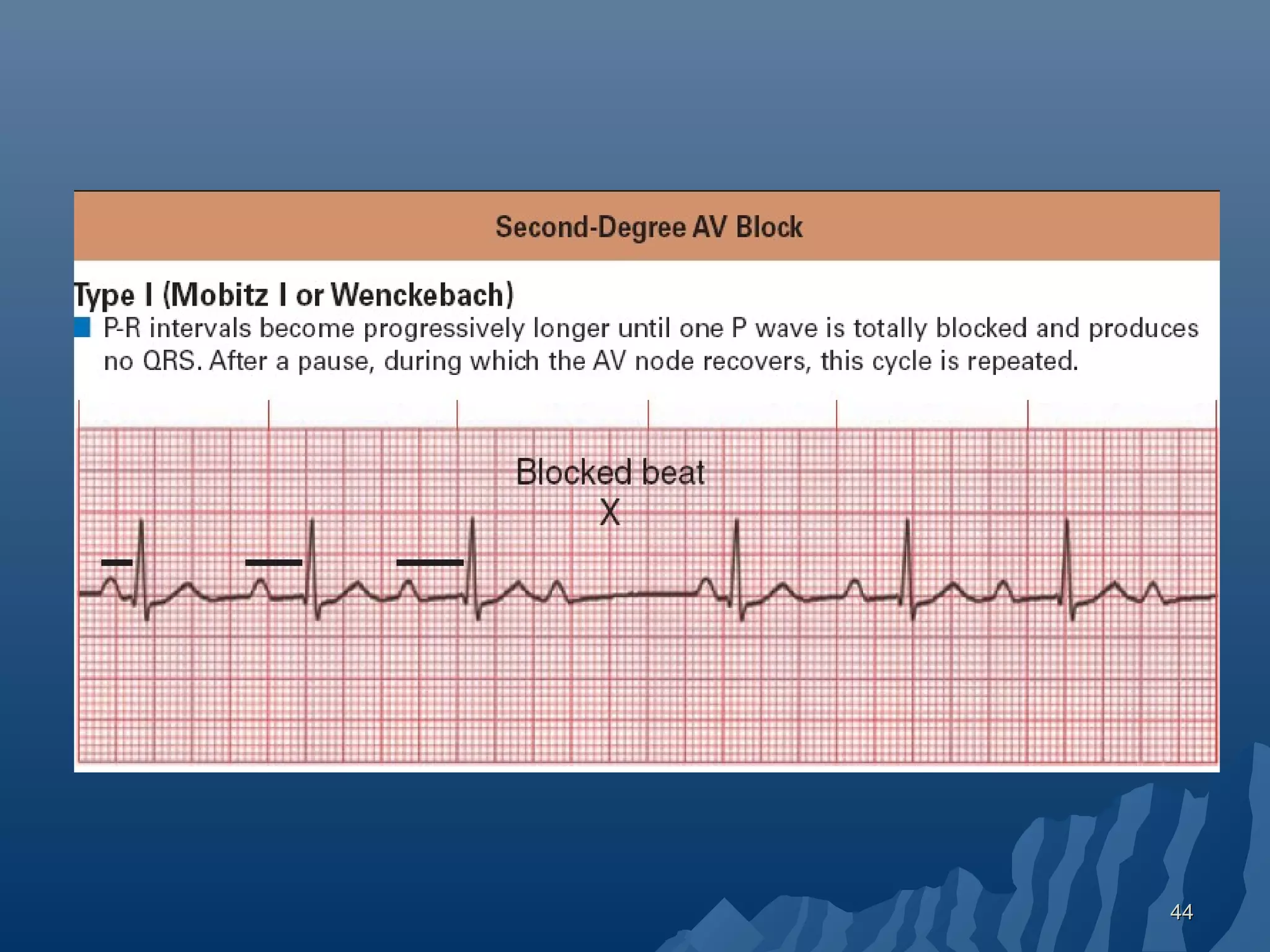 ECG, Conduction disturbances | PPT