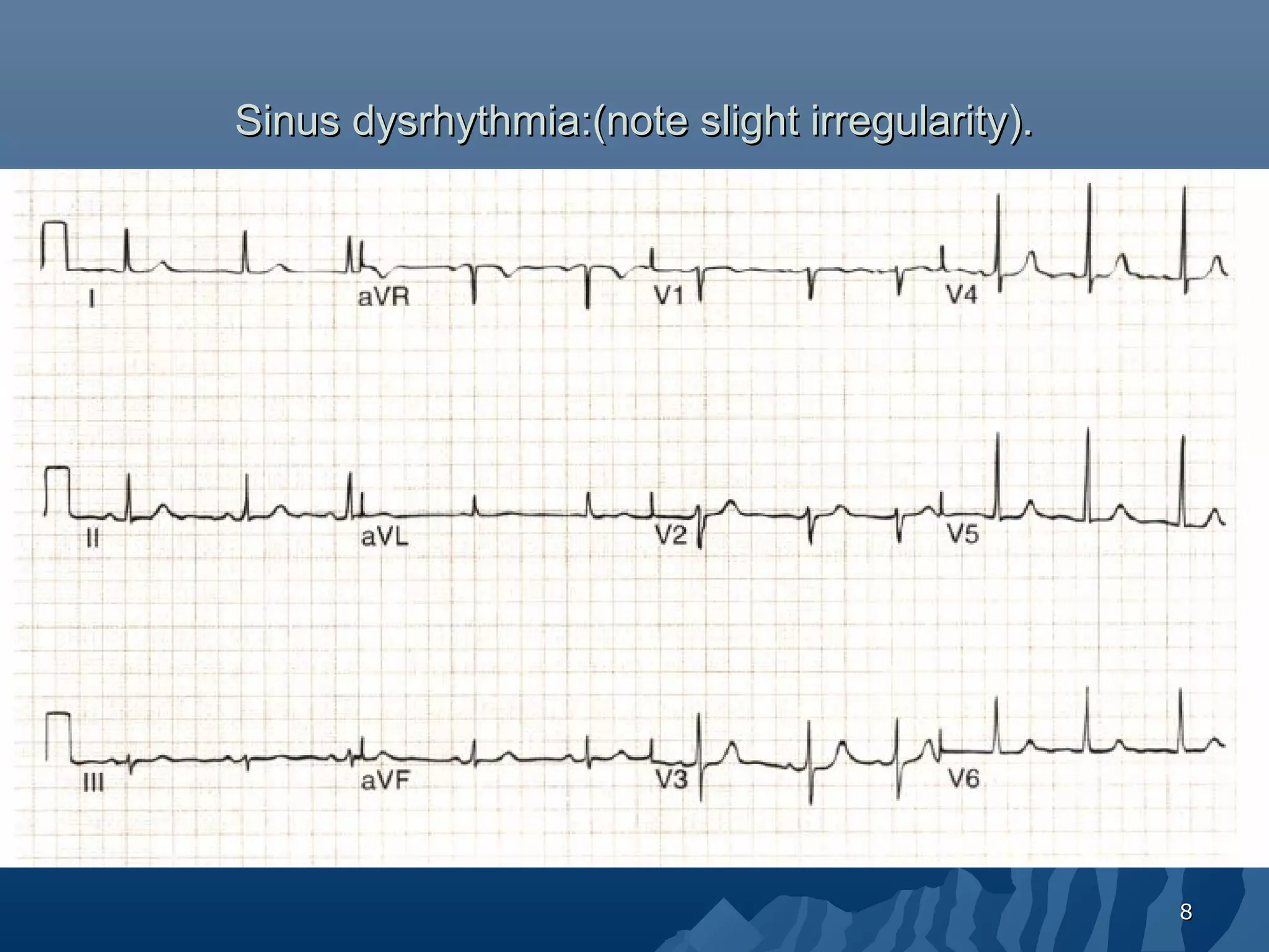 ECG, Conduction disturbances | PPT