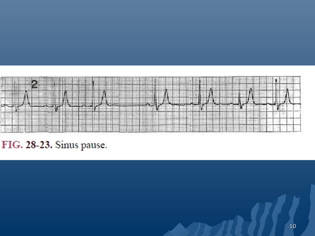 ECG, Conduction disturbances | PPT