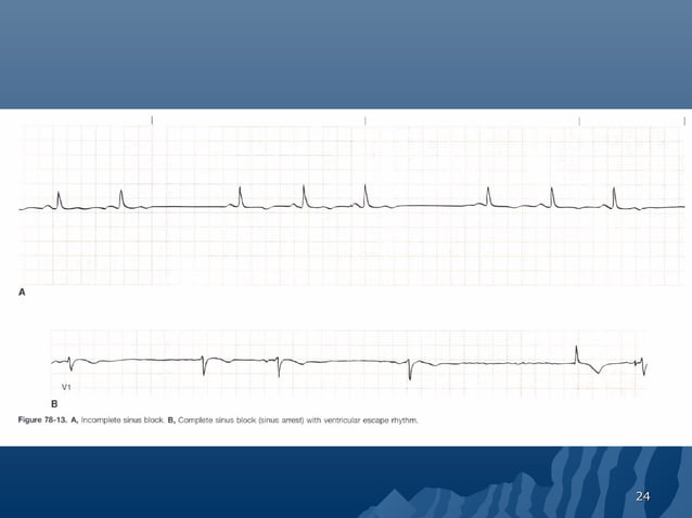 ECG, Conduction disturbances | PPT