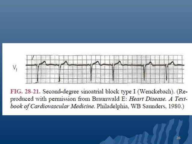 ECG, Conduction disturbances | PPT