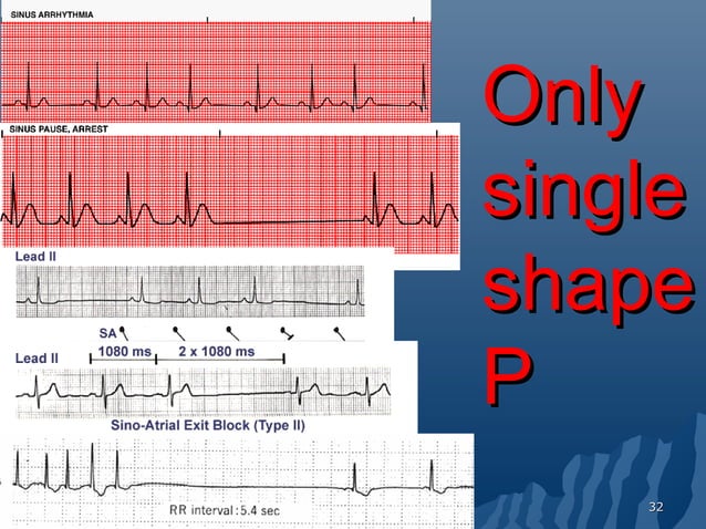 ECG, Conduction disturbances | PPT