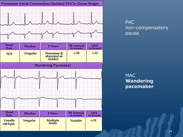 ECG, Conduction disturbances | PPT