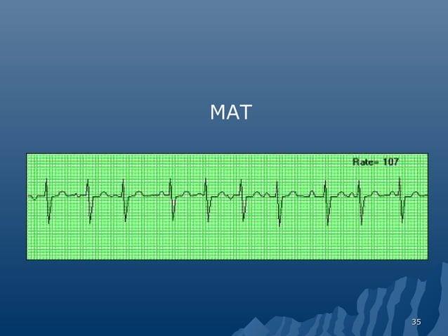 ECG, Conduction disturbances | PPT