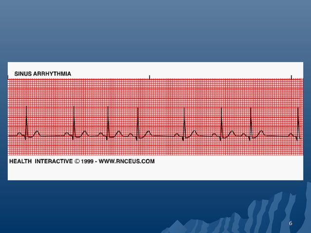 ECG, Conduction disturbances | PPT