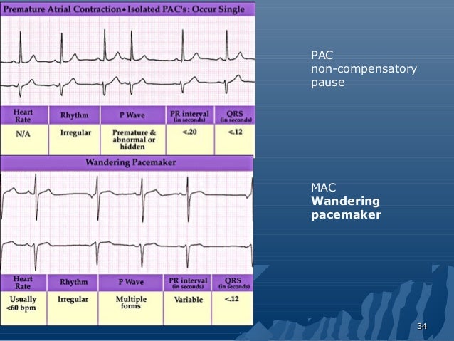 ECG, Conduction disturbances