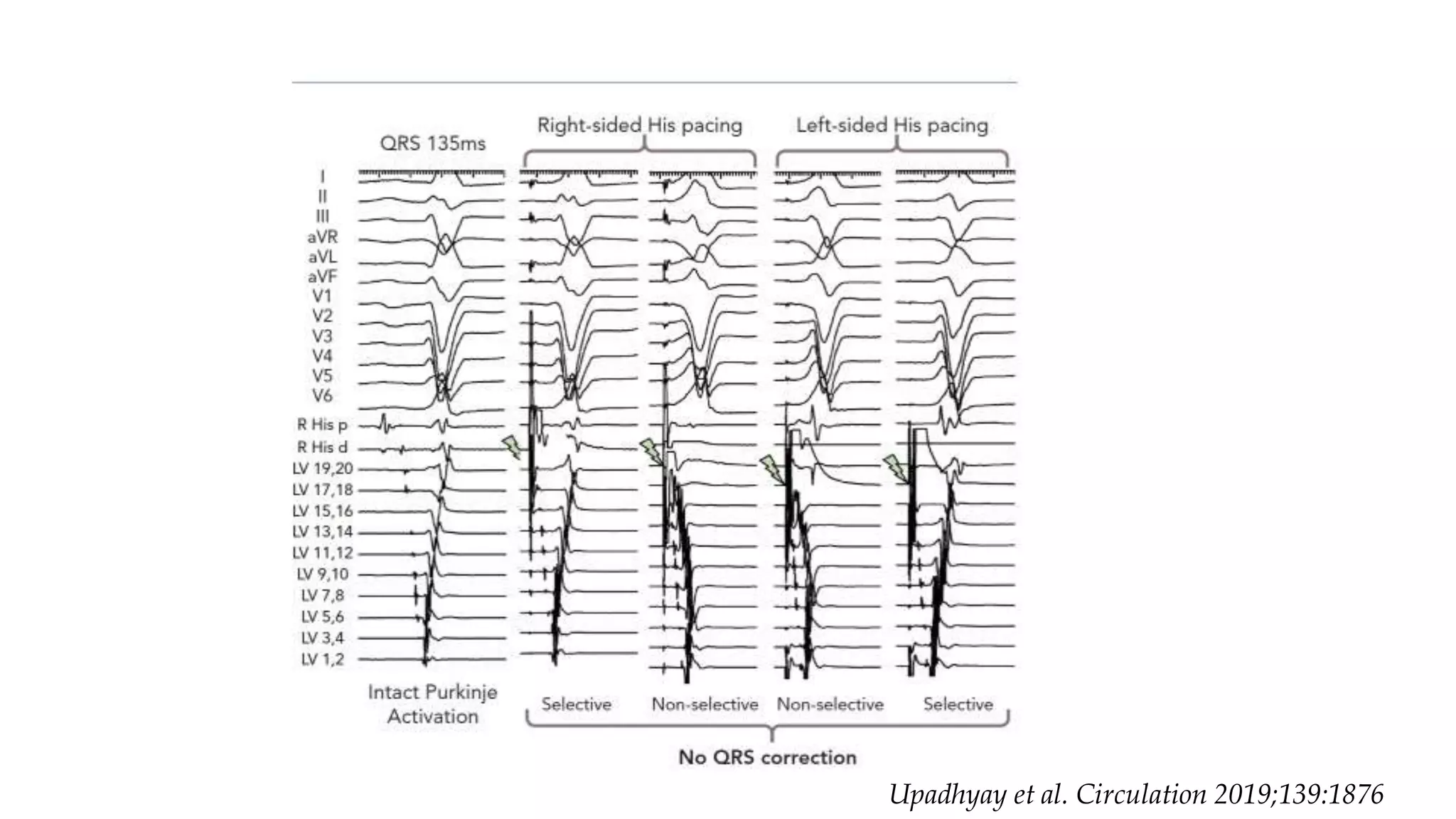 Conduction system pacing as resynchronization | PPTX