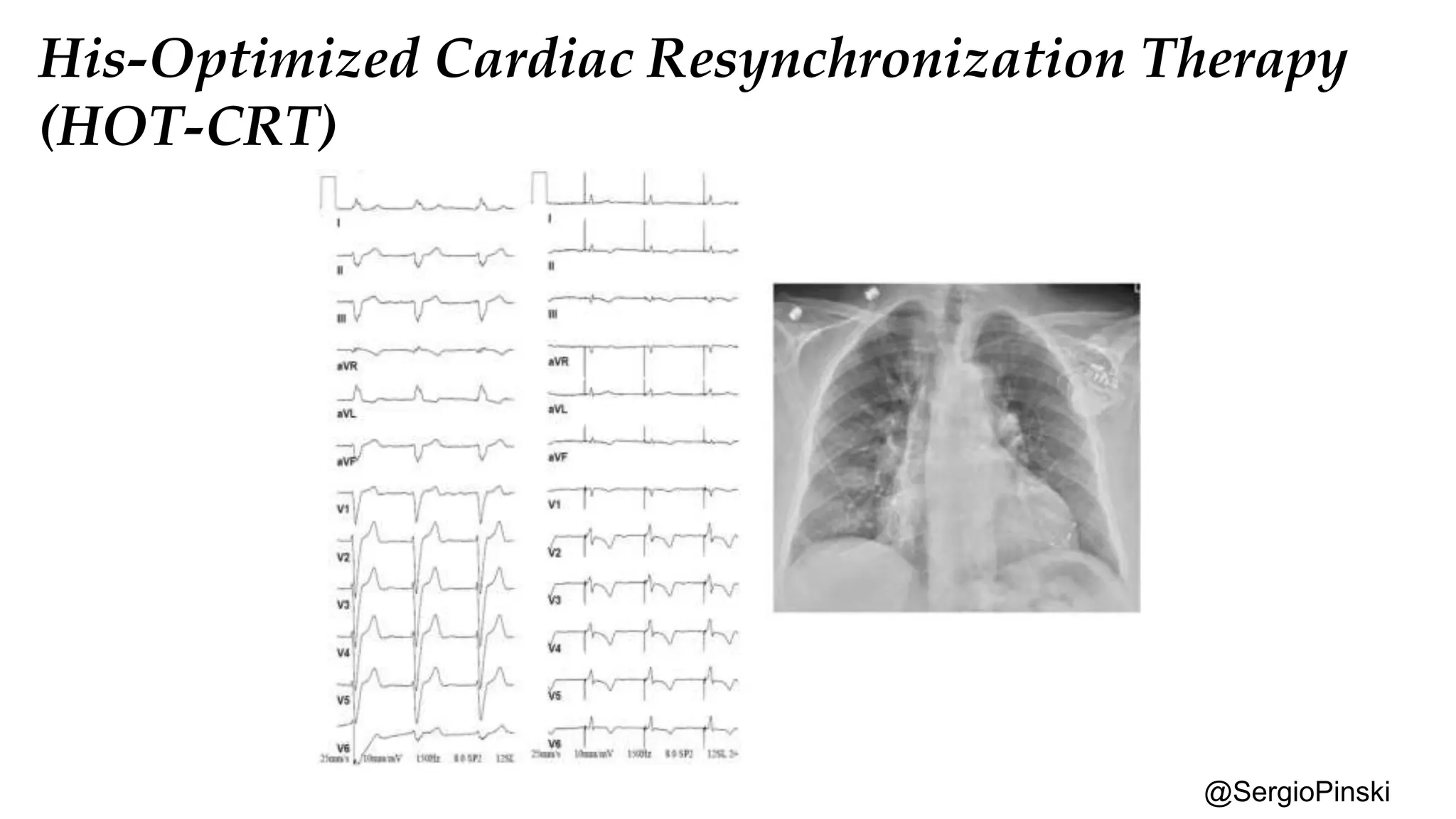 Conduction system pacing as resynchronization | PPTX