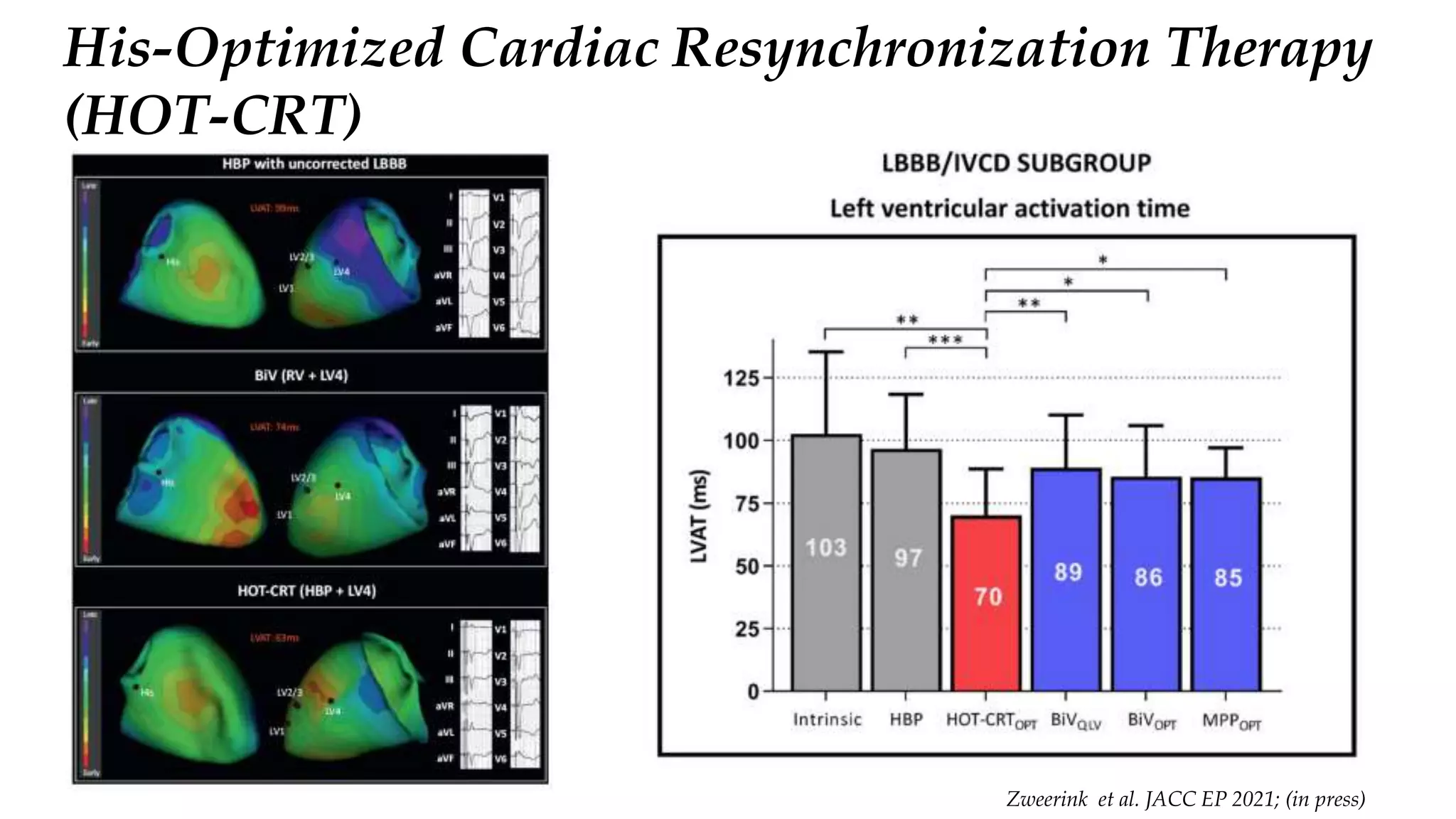 Conduction system pacing as resynchronization | PPTX