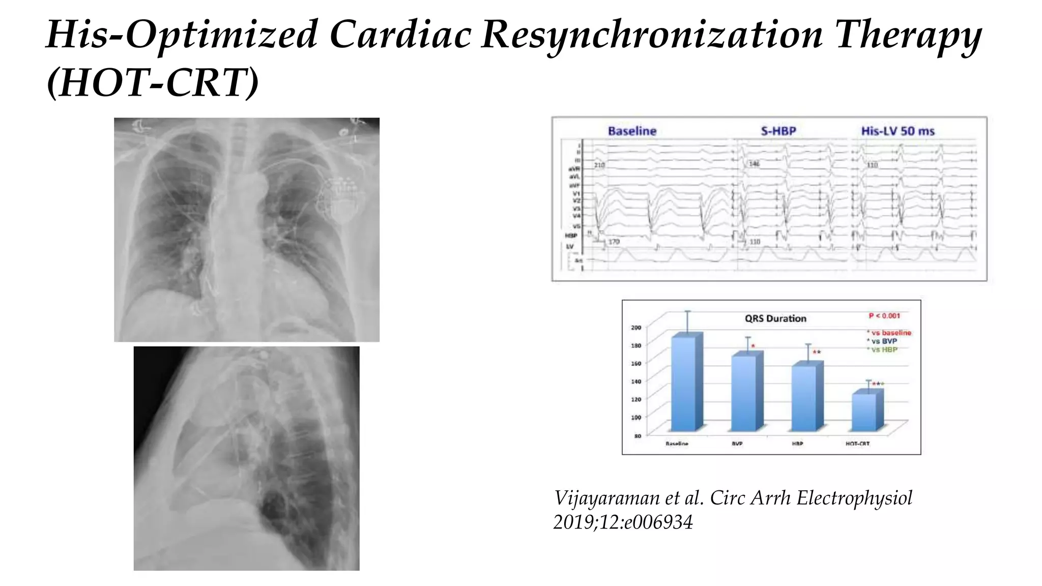 Conduction system pacing as resynchronization | PPTX
