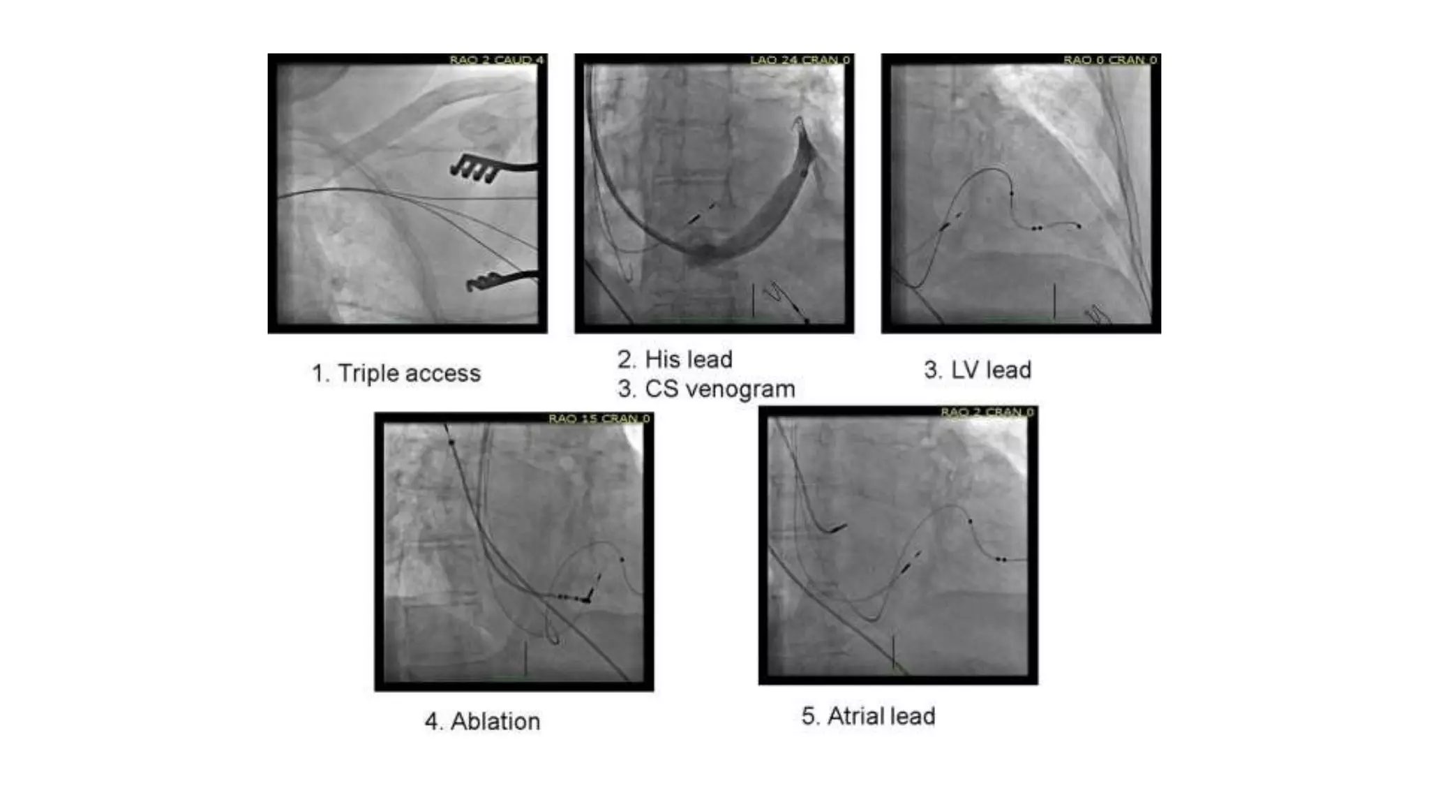 Conduction system pacing as resynchronization | PPTX