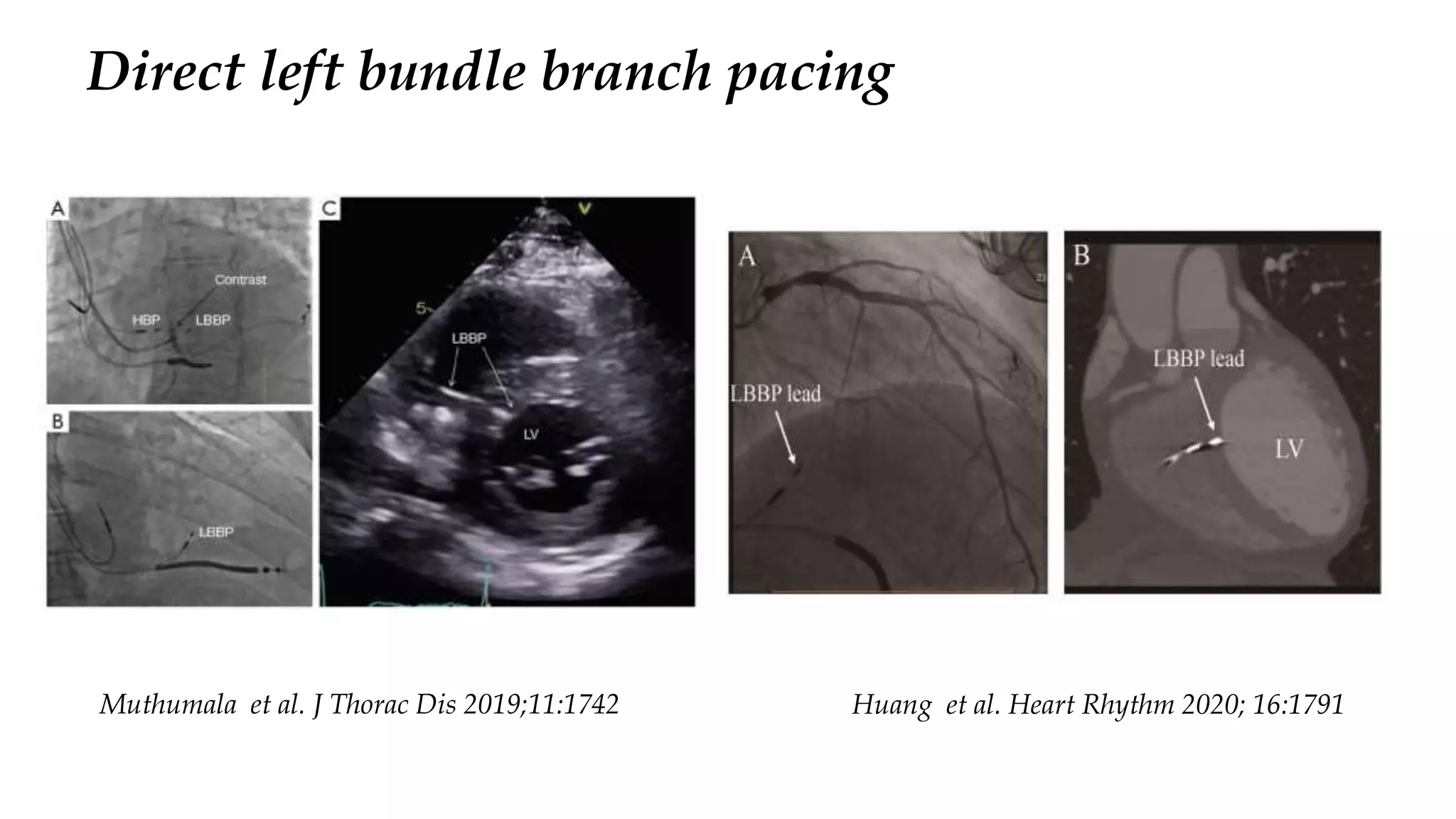Conduction system pacing as resynchronization | PPTX