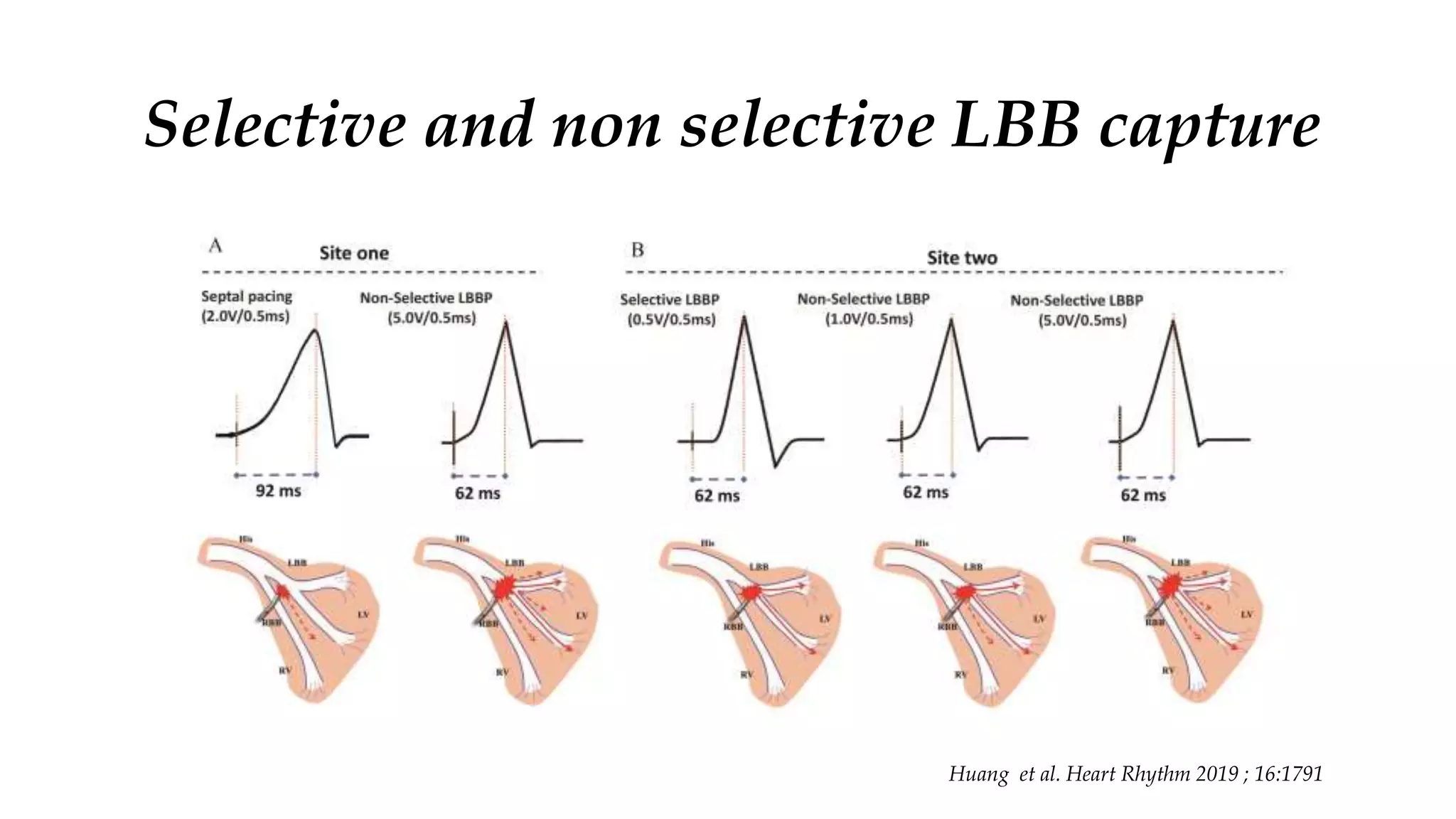 Conduction system pacing as resynchronization | PPTX