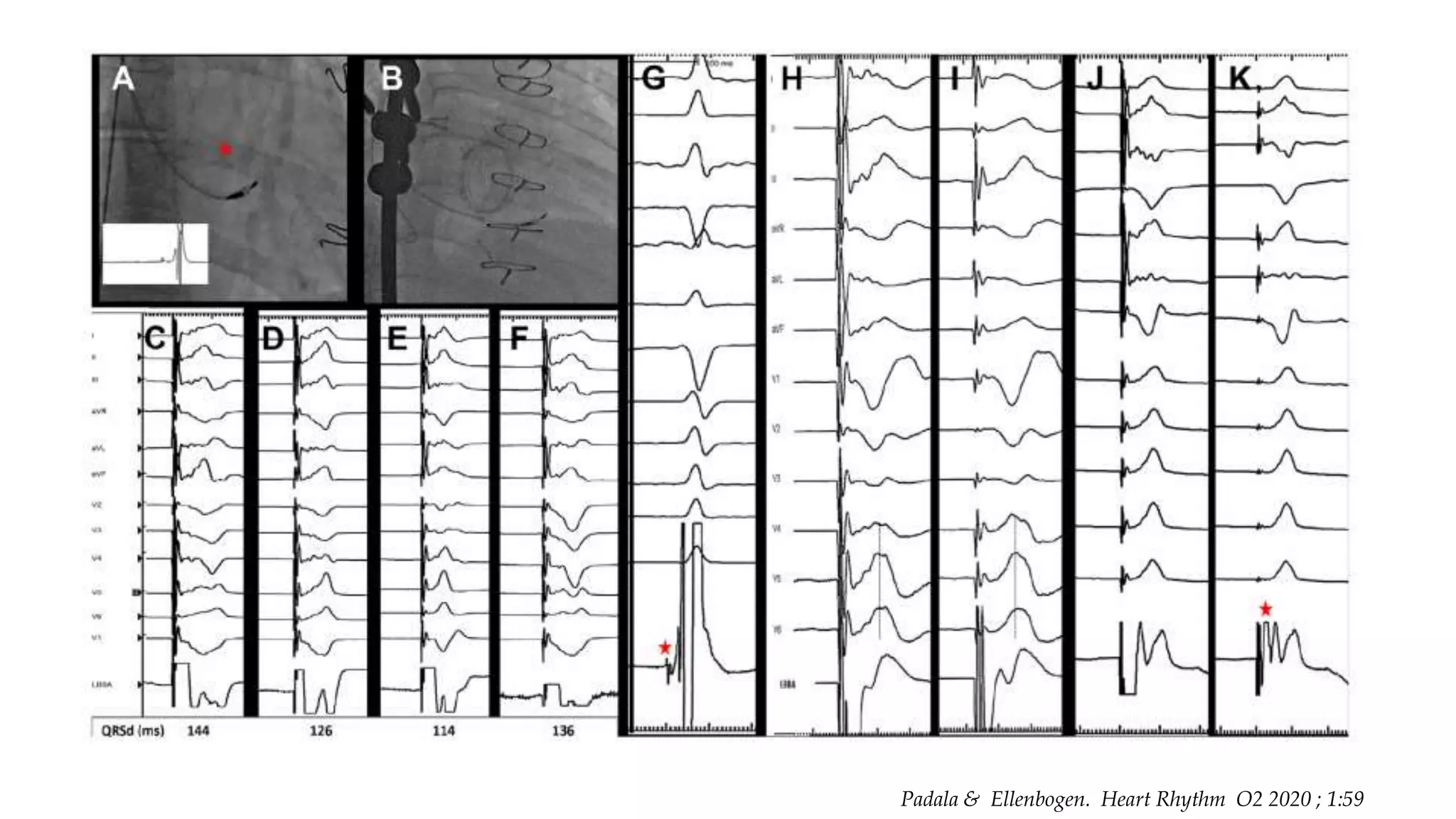 Conduction system pacing as resynchronization | PPTX