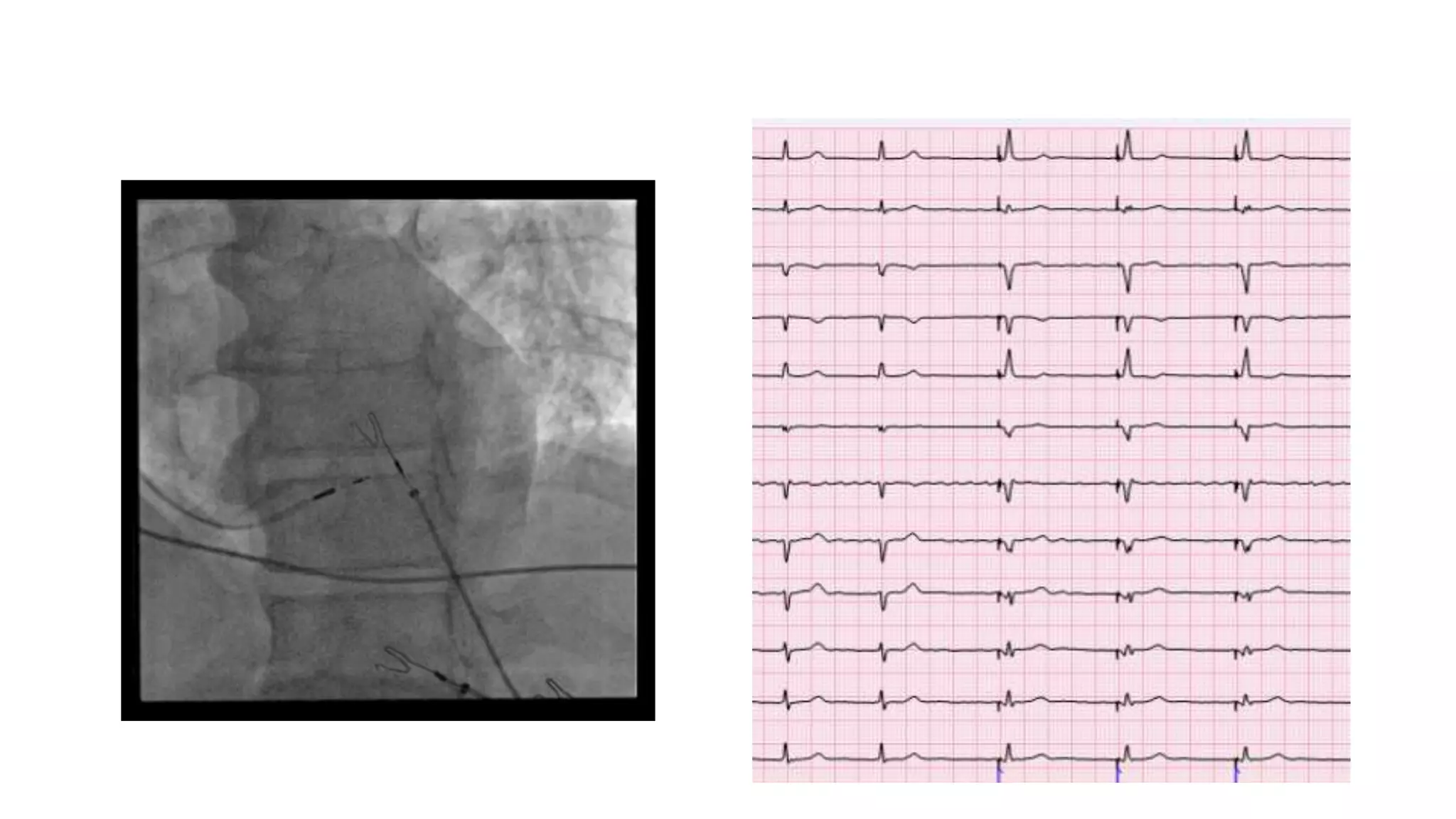 Conduction system pacing as resynchronization | PPTX
