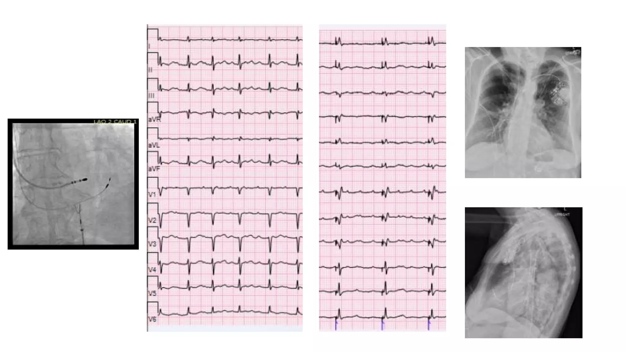 Conduction system pacing as resynchronization | PPTX
