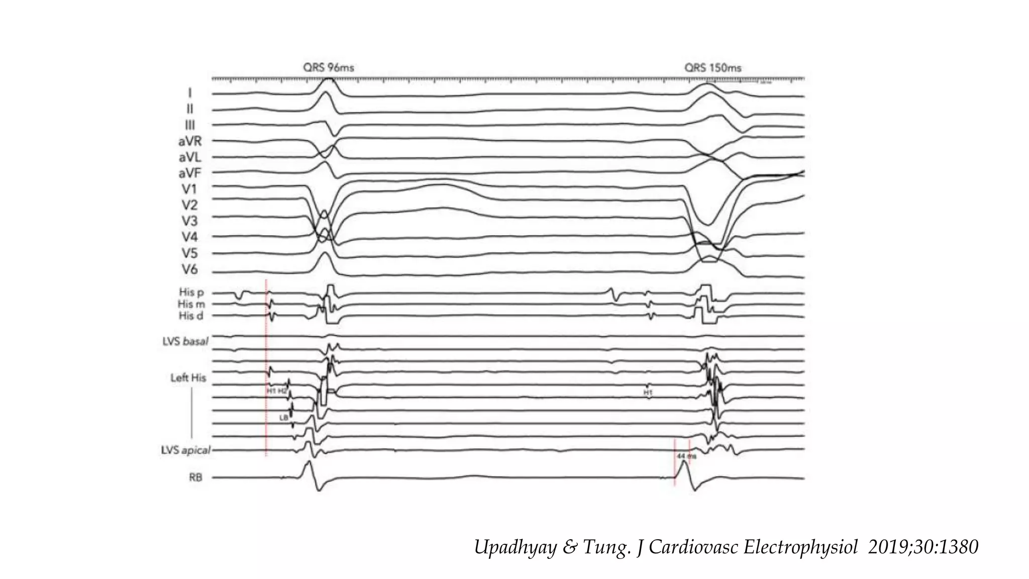 Conduction system pacing as resynchronization | PPTX