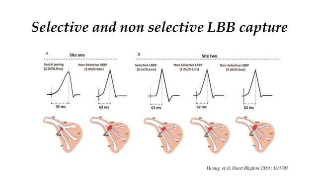 Conduction system pacing as resynchronization | PPTX