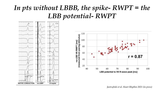 Conduction system pacing as resynchronization | PPTX