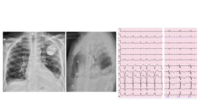 Conduction system pacing as resynchronization | PPTX