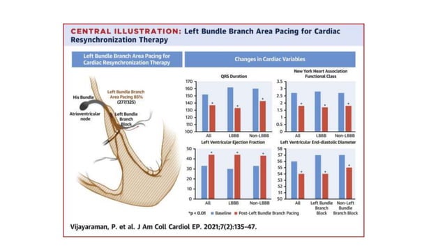 Conduction system pacing as resynchronization | PPTX