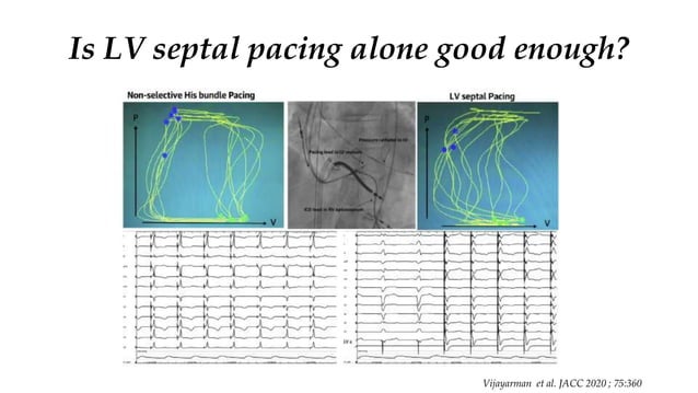 Conduction system pacing as resynchronization | PPTX