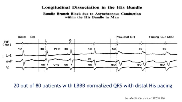 Conduction system pacing as resynchronization | PPTX