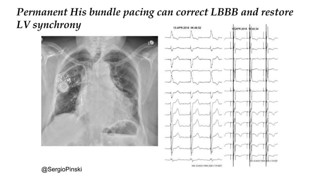 Conduction system pacing as resynchronization | PPTX